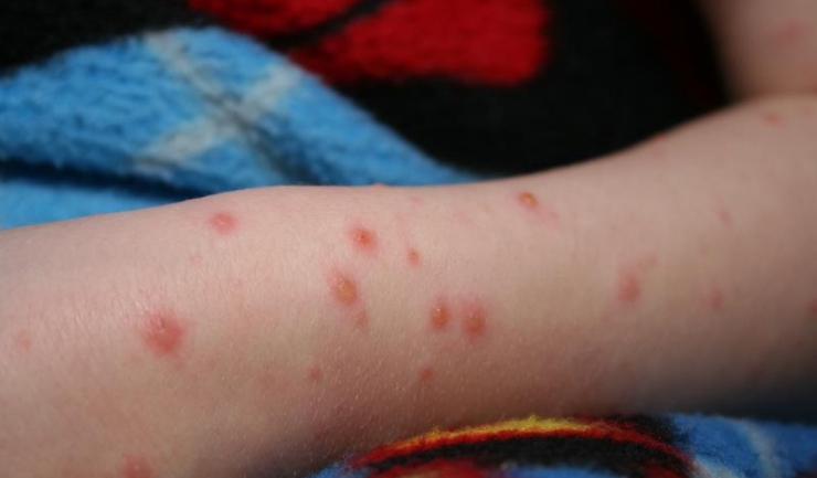 Creşterea numărului de cazuri de rujeolă în Europa. Boala a revenit în ...